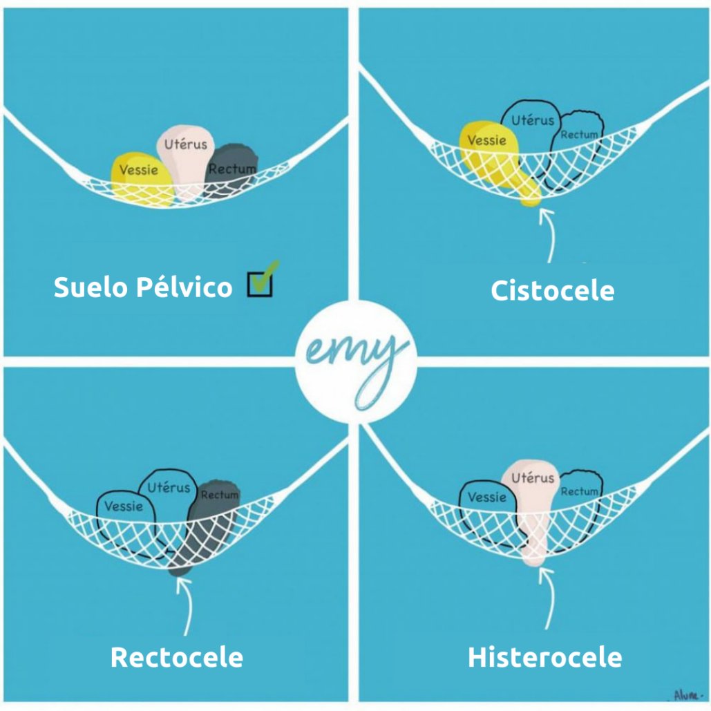 Rectocele, ¿cómo solucionarlo? - Descubre Emy de Fizimed